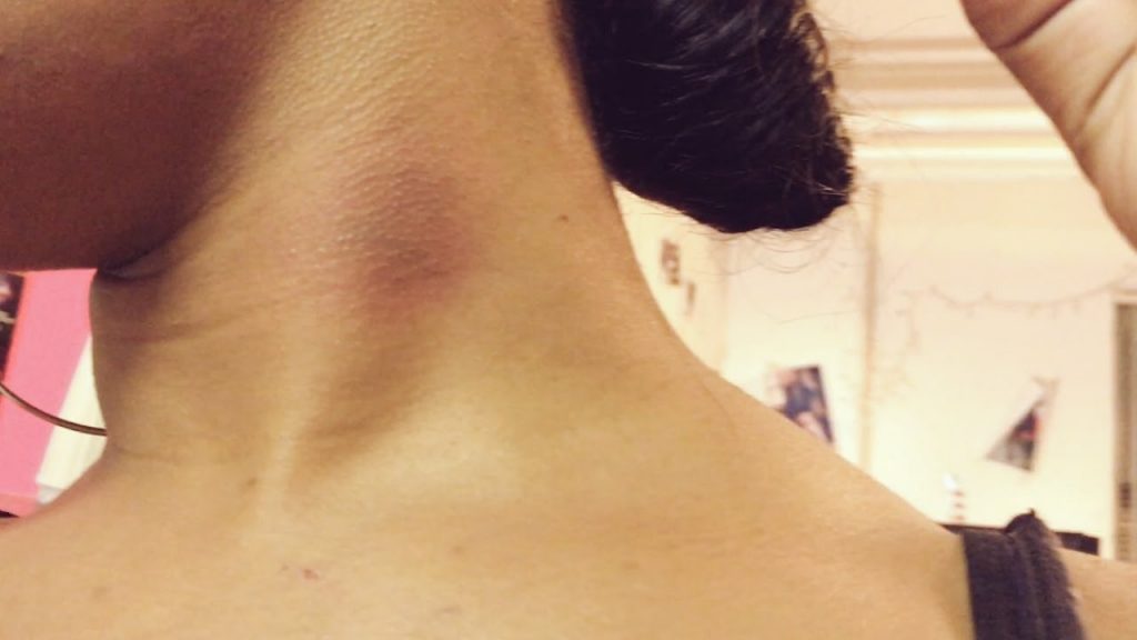 Best Remedies to Get Rid of An Embarrassing Hickeys! - CRAZY SPEED TECH